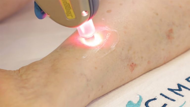 Tecnología láser en tratamiento de varices: eficaz, segura y sin cirugía
